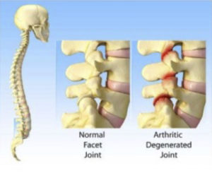 Facet Joint Neurotomies (Rhizotomies) - PainScience