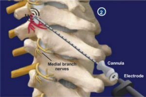 Facet Joint Neurotomies (Rhizotomies) - PainScience