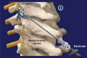 Facet Joint Neurotomies (Rhizotomies) - PainScience
